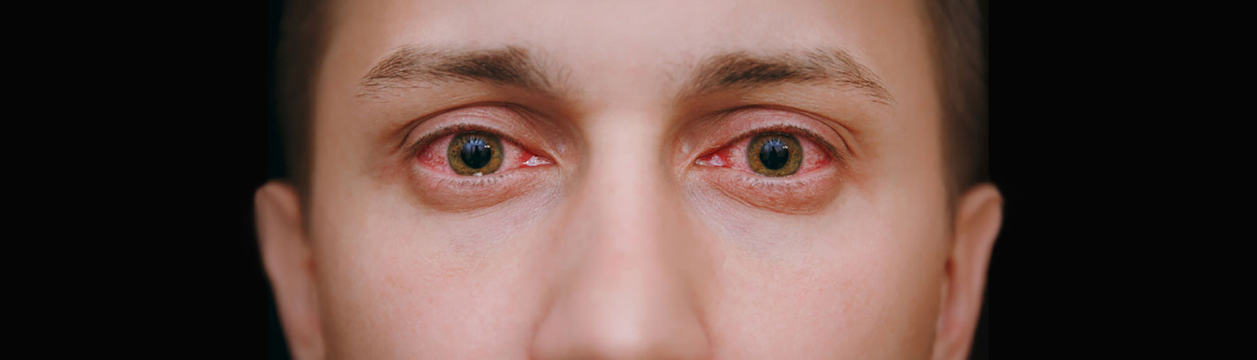 Why Allergies Make Your Eyes Red and Itchy - Cliradex® – PRN Vision Group